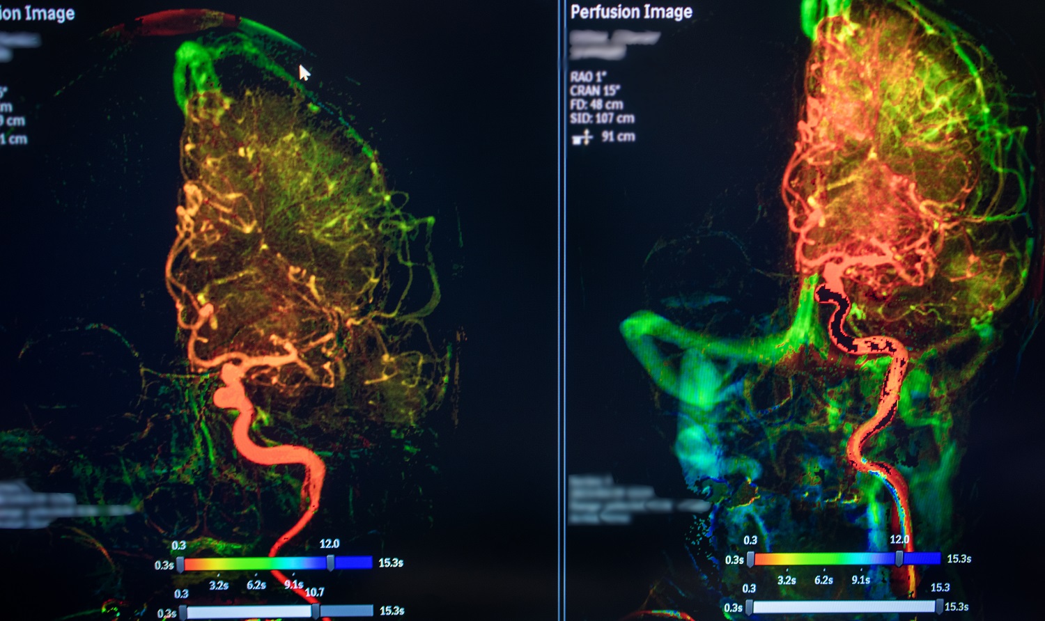 USF professors focus diverse skills into life-saving stroke device ...